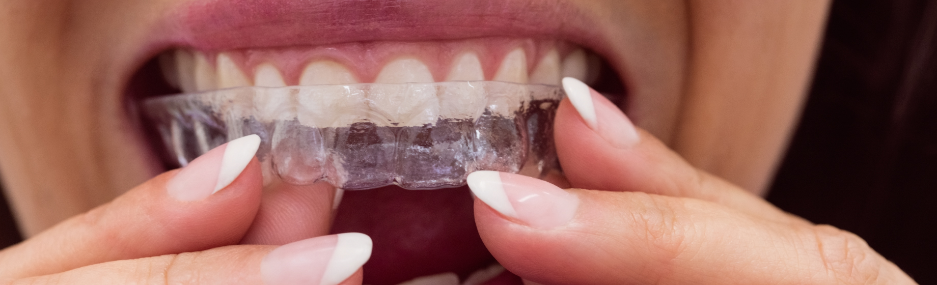 Invisalign Adult Treatment Roanoke Adult Orthodontic Va