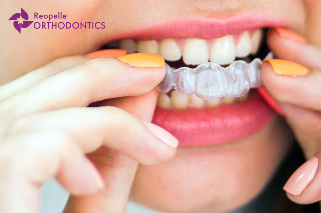 How Can I Straighten Teeth Without Braces? - Reopelle Orthodontics