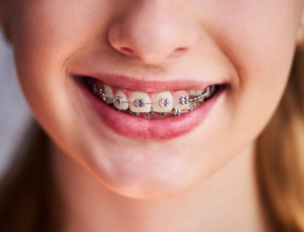 How to Choose the Right Type of Braces for Your Lifestyle - Reopelle ...